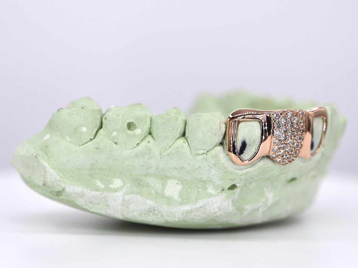 1 Tooth Diamond & 2 Teeth Open Faced VVS Moissanite Diamond Grillz ...